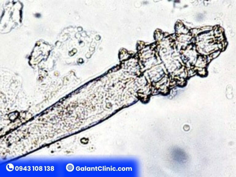Ký Sinh Trùng Demodex Là Gì? Triệu Chứng Nhiễm Demodex